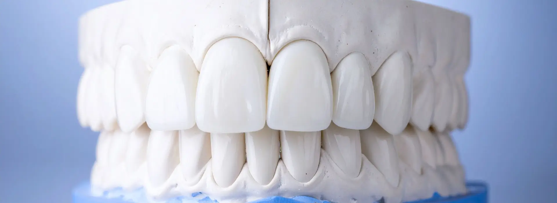 Do Veneers Damage Your Teeth? Dental Pro & Con Guide